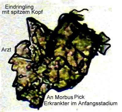 Die Demenz-Erkrankung Morbus Pick ist ansteckend! – WILHELM JOSEF GIEBEL