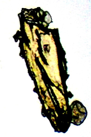 Die Demenz-Erkrankung Morbus Pick ist ansteckend! – WILHELM JOSEF GIEBEL