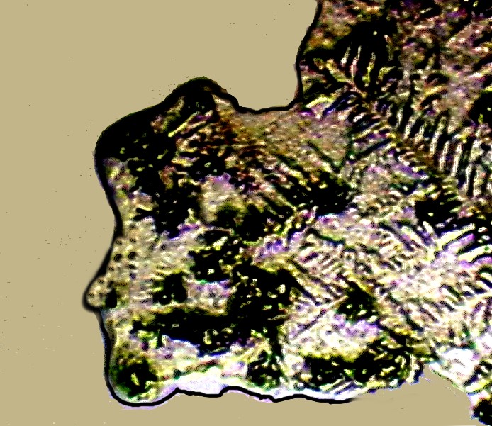 Die Demenz-Erkrankung Morbus Pick ist ansteckend! – WILHELM JOSEF GIEBEL