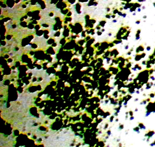 Die Demenz-Erkrankung Morbus Pick ist ansteckend! – WILHELM JOSEF GIEBEL